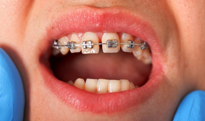 ¿Cómo se colocan los brackets? | Clínica Dental Ortoperio
